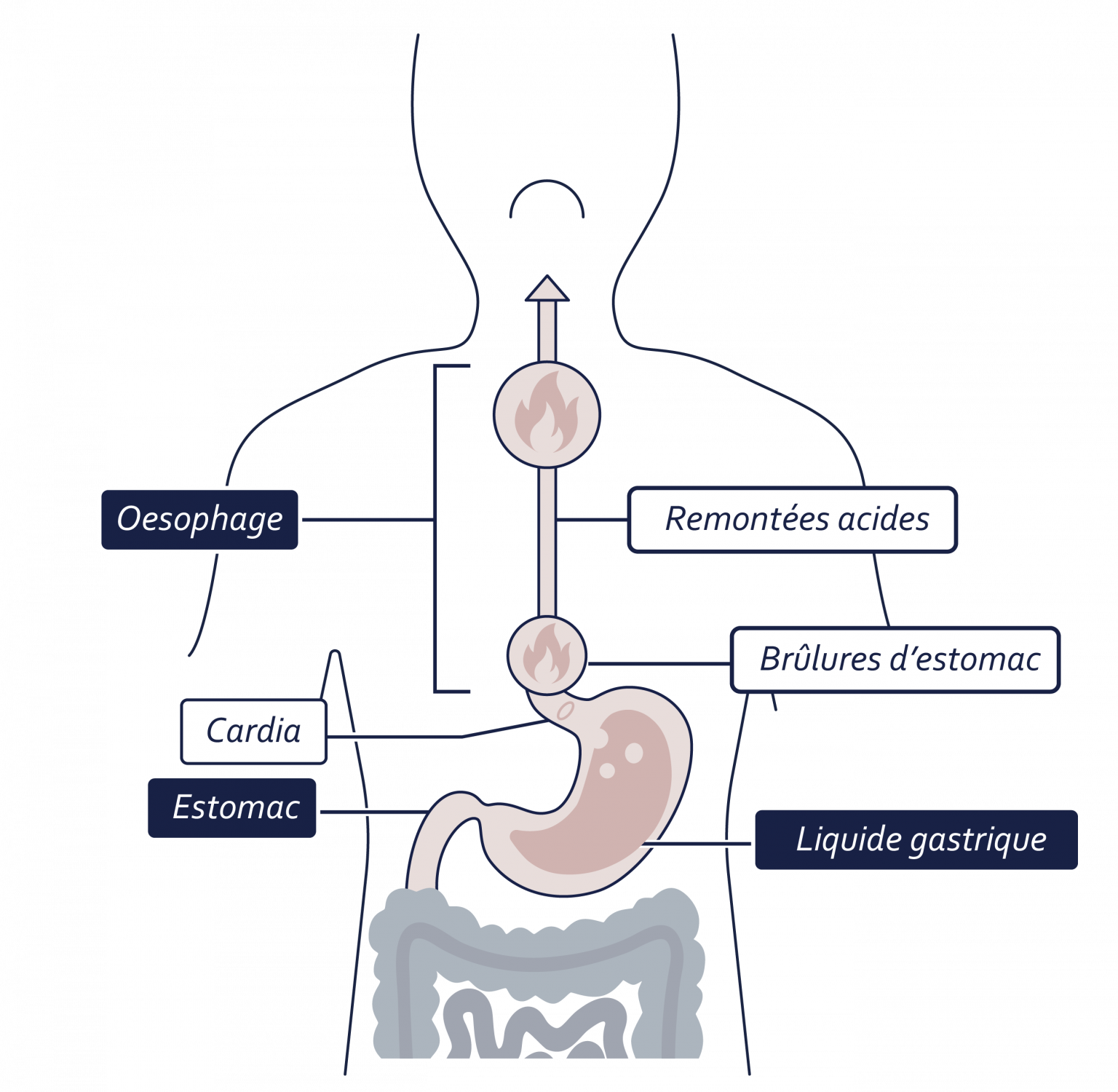 Reflux gastro-œsophagien (RGO) - Laboratoires Grimberg